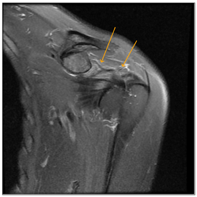 Adhesive Capsulitis : MRI - Sumer's Radiology Blog