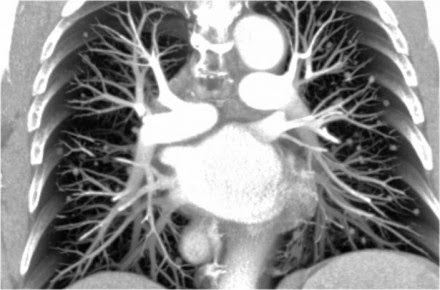 Chest Medicine Made Easy-Dr Deepu: BASICS OF CHEST X RAY-PART 5, THE ...