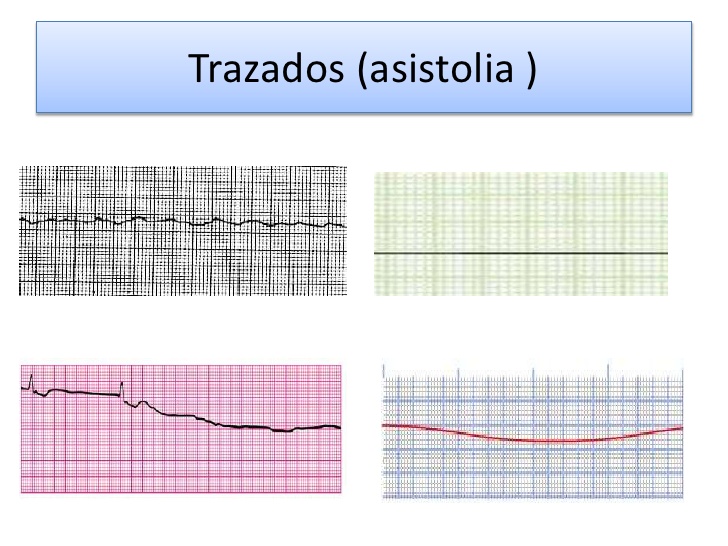 REANIMACIÓN CARDIOPULMONAR AVANZADA : RITMOS DESFIBRILABLES Y NO ...