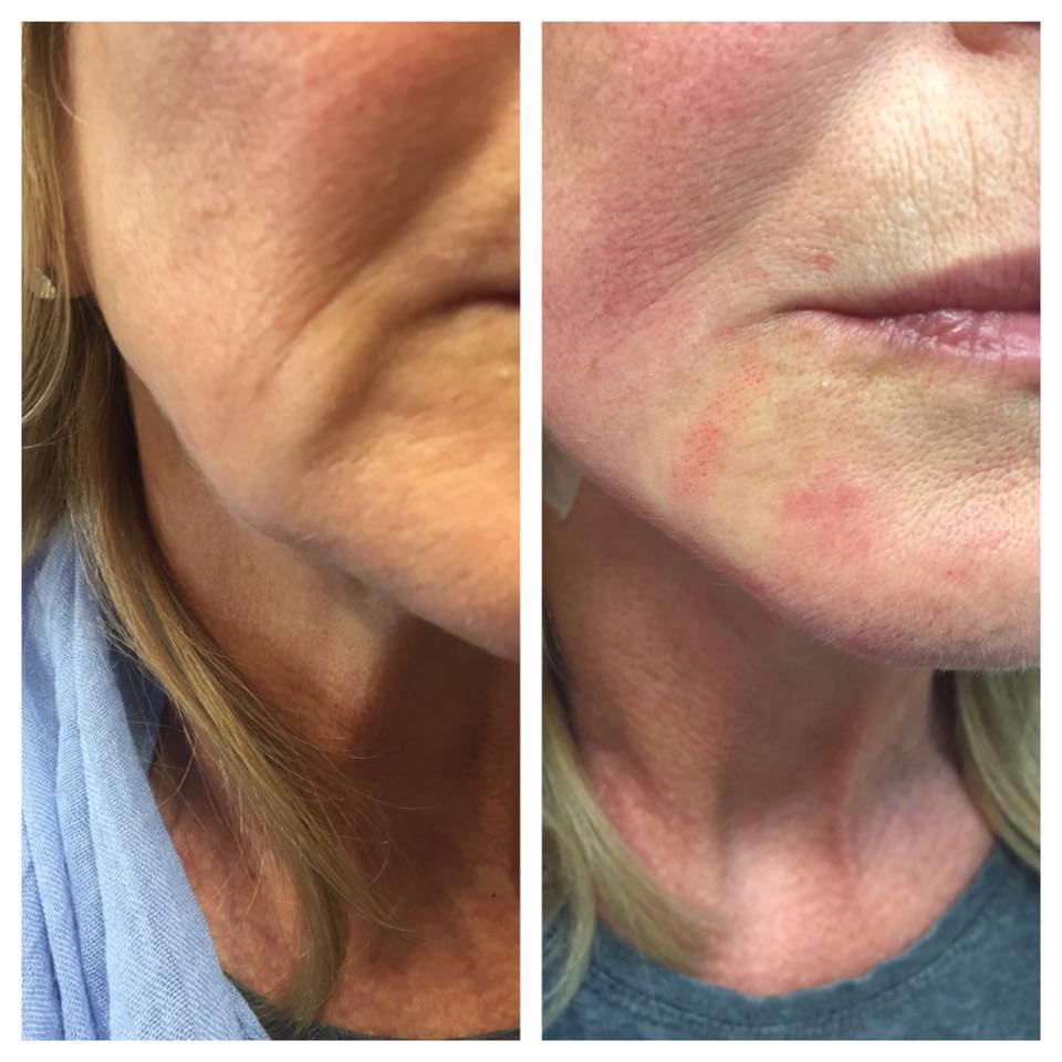 Selston Cosmetic Clinic: Improve an Ageing Face with a PDO Thread Lift ...