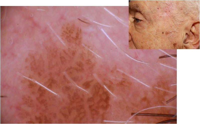 Dermatoscopia: Fingerprinting & Fat Fringers