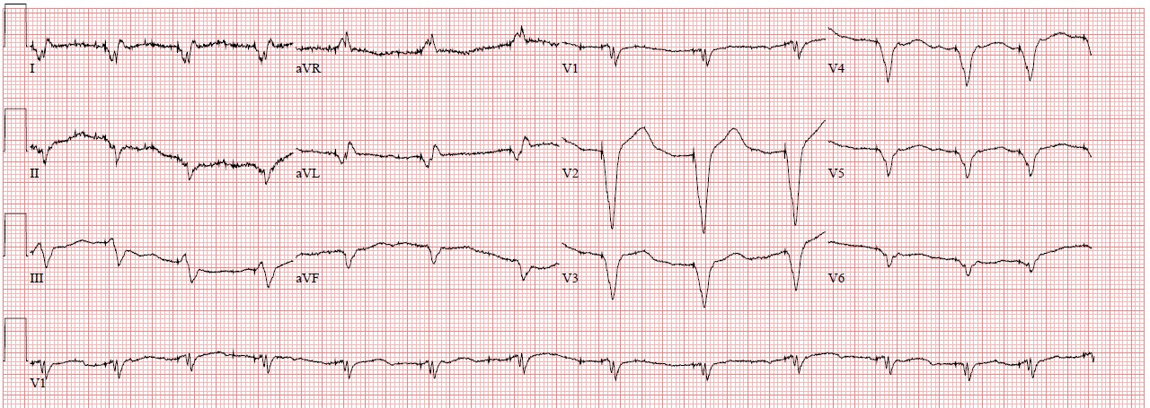 Medicowesome: Determining pacemaker type from EKG (RV pacing vs ...