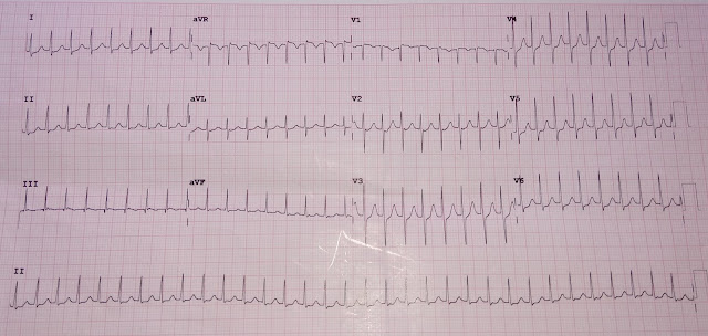 Cardiology window: PSVT (AVNRT)