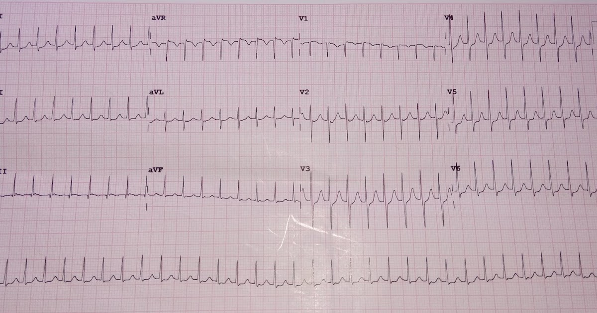 Cardiology window: PSVT (AVNRT)