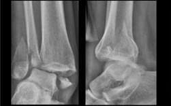 ZONA RADIOLOGY: Teknik Pemeriksaan Radiografi Ankle Joint