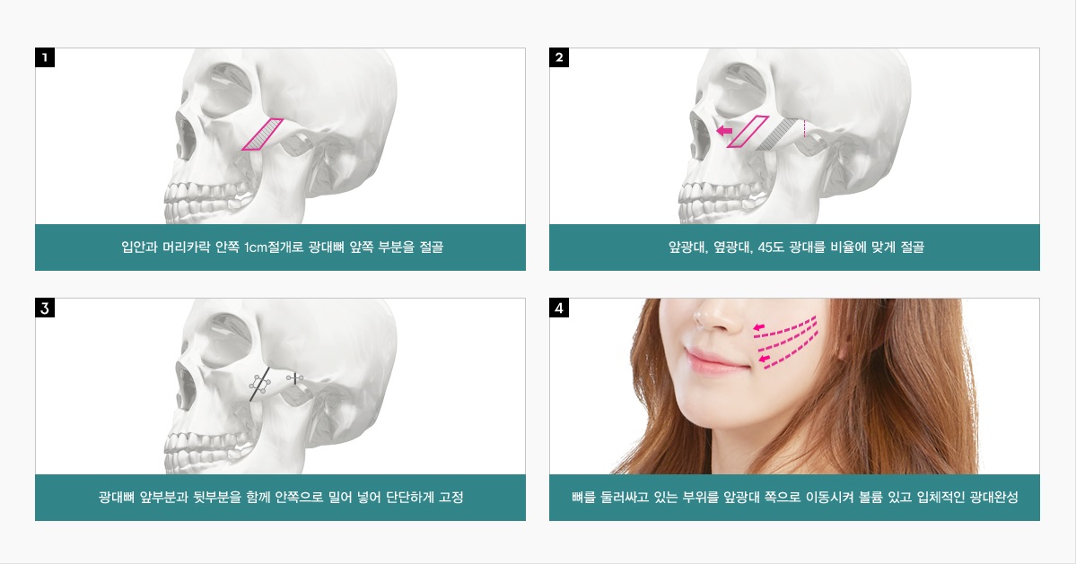 [Facial Contouring] Zygoma (Cheekbone) Reduction