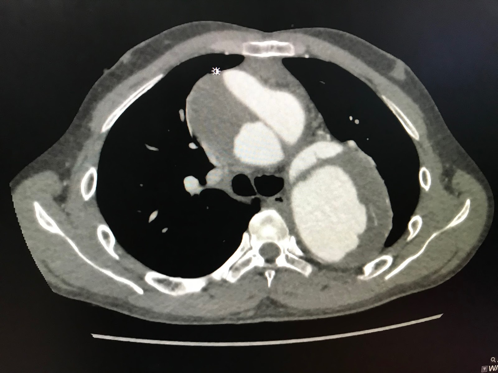 VIETNAMESE MEDIC ULTRASOUND: CASE 490: ANECHOIC CRESCENT' S SIGN OF ...