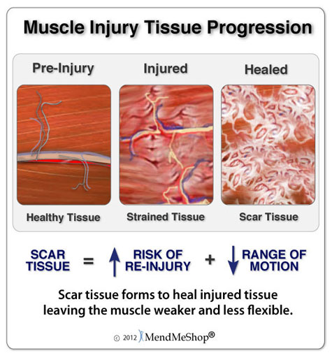 Megan's ACI Carticel Surgery: 10 Weeks Post Op