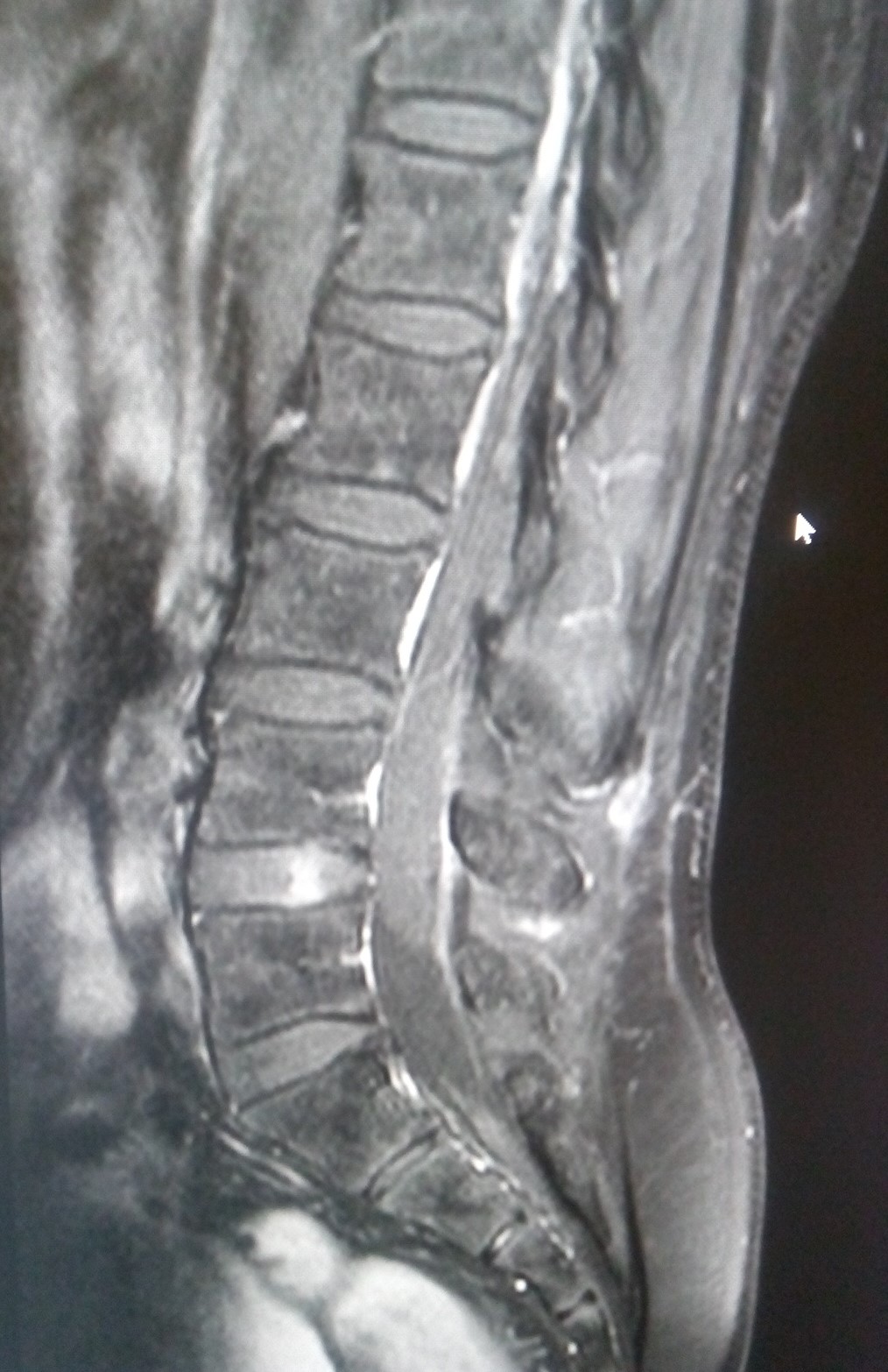 Cauda equina mass: An Approach - Sumer's Radiology Blog