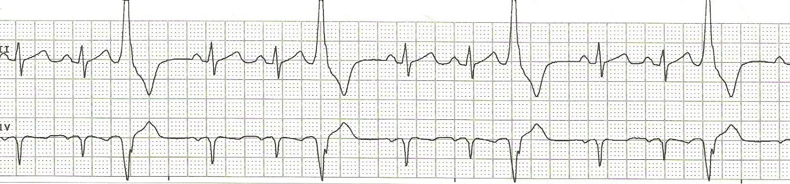 ECG Rhythm Strip Quiz 61
