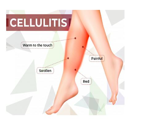 CELLULITIS