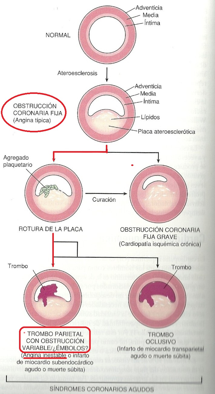 Patología : CARDIOPATÍA ISQUÉMICA