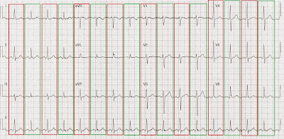 ECG of the Week: ECG of the Week - 25th May 2015 - Interpretation