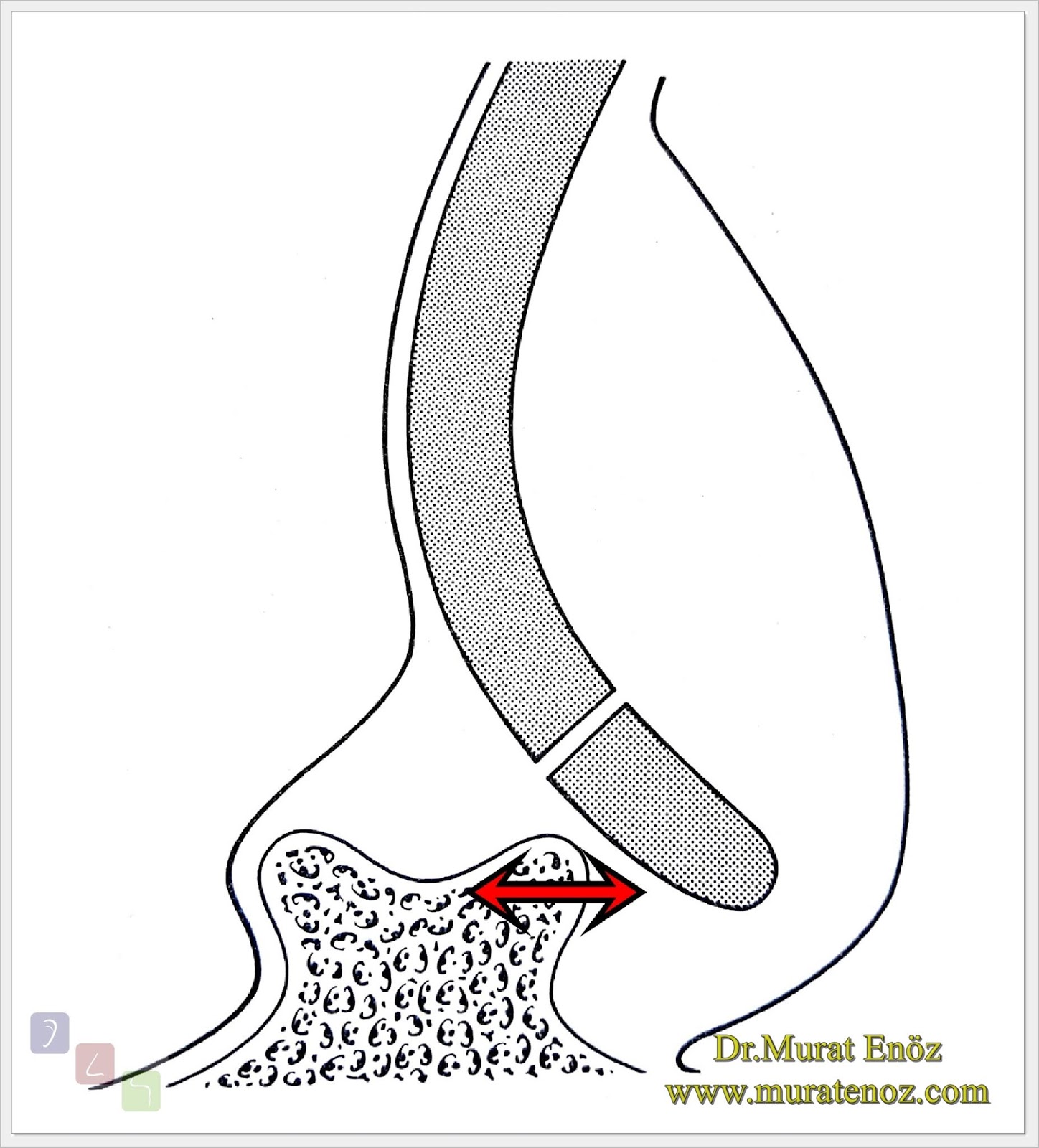Kaudal Septoplasti ve Eksternal Strut Greft İle Burun Ucu Kaldırma