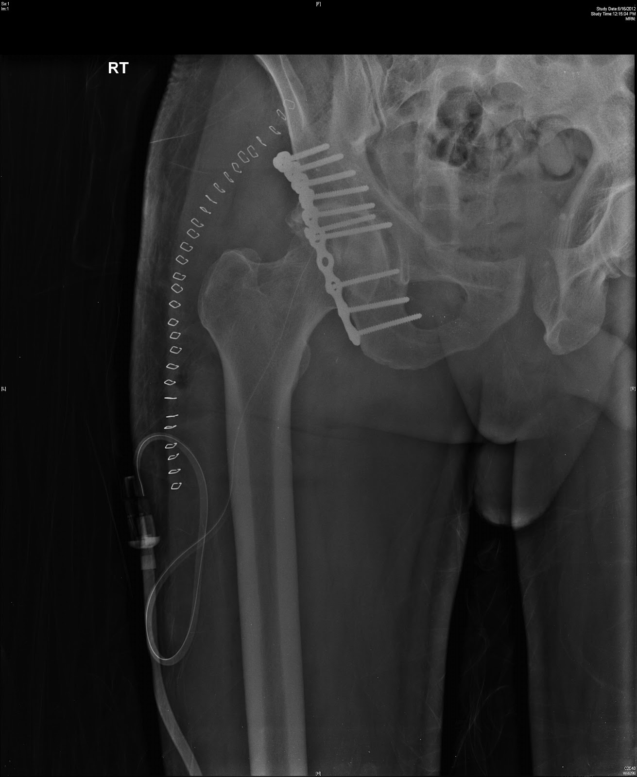 Acetabular Reconstruction