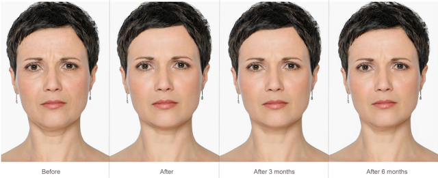 The Best Natural Anti aging and Wrinkle Remover ( Ageless Body System ...