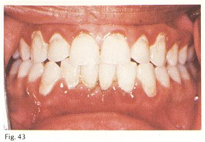 Kesan pertama: Gingivitis