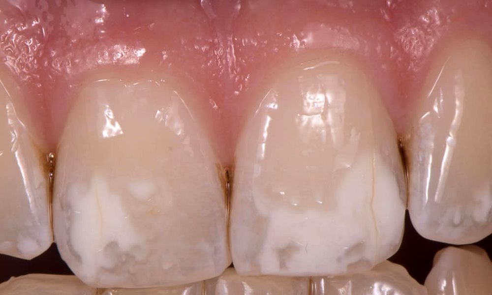 Here's why some people have white spots on their teeth