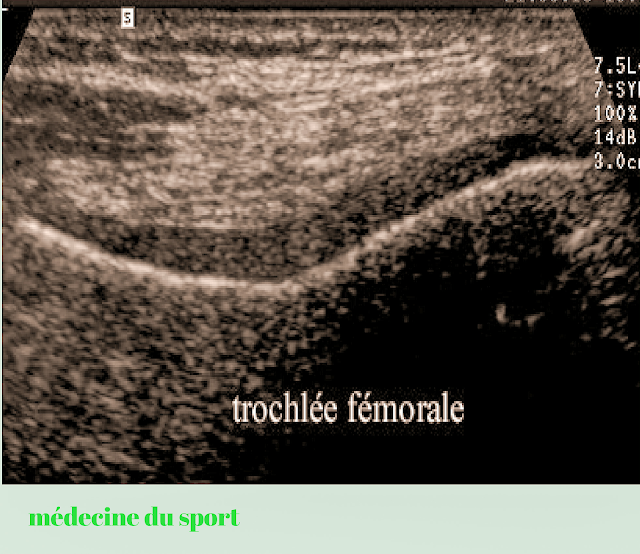 IMAGERIE DU GENOU APPLIQUÉE A LA PATHOLOGIE SPORTIVE