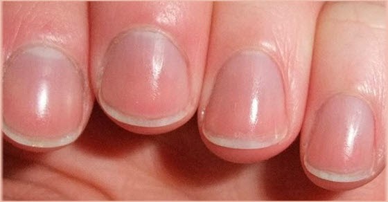 Promene na noktima ruku ~ Biljem Lijecenje Bolesti