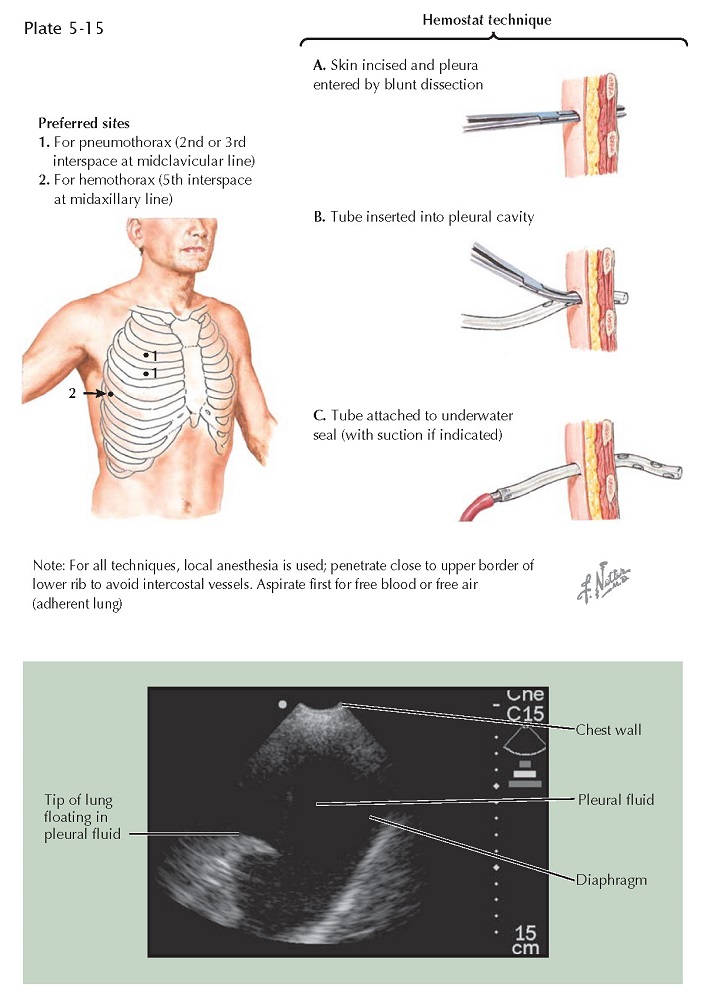 INTRODUCTION OF CHEST DRAINAGE TUBES - pediagenosis