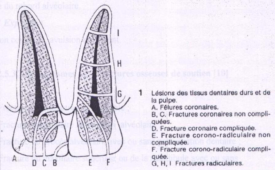 Fractures dentaires; Fractures de dents; Fractures des dents