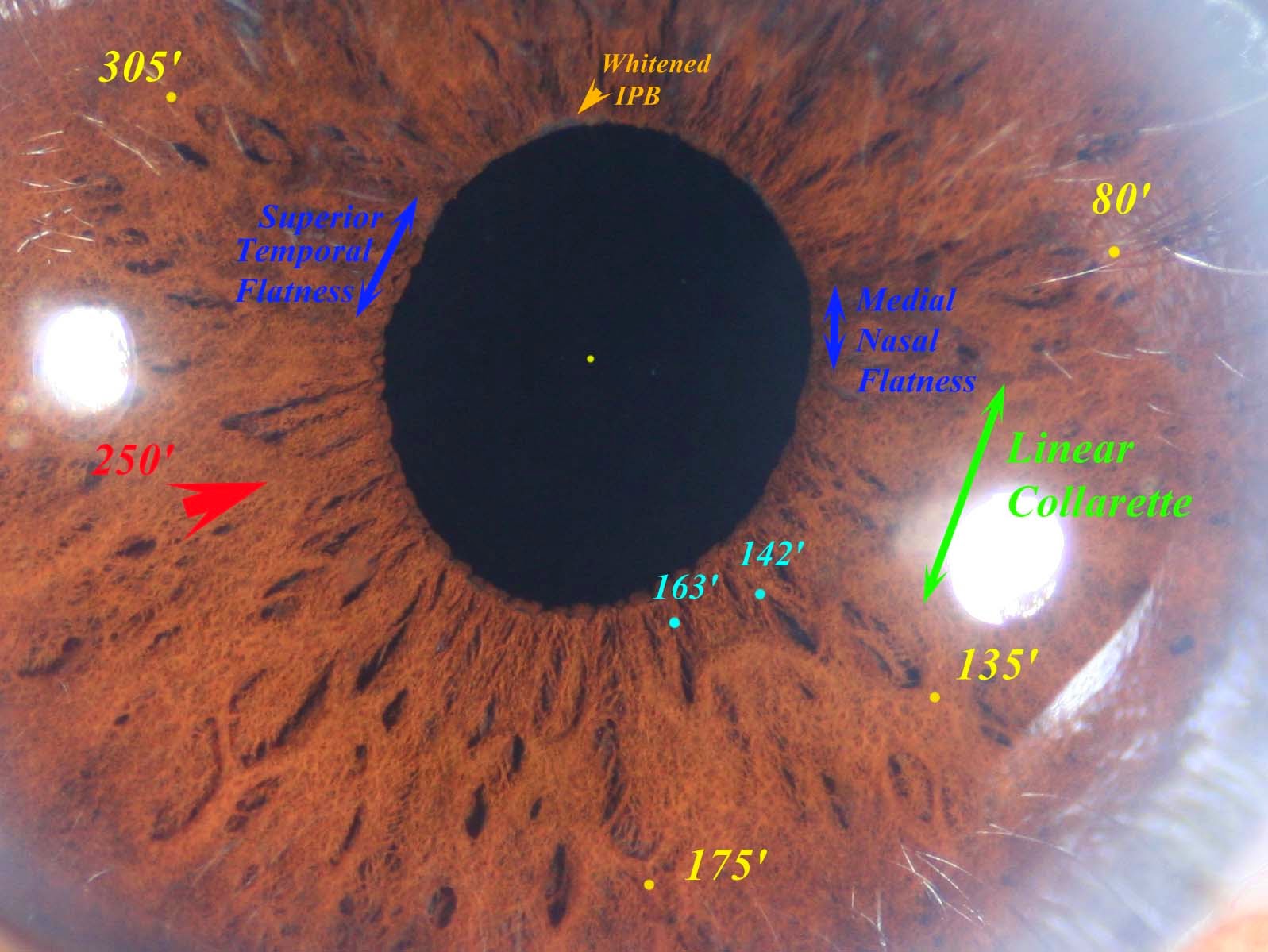 Modern & Multidimensional Iridology: Identification of Correlation Iris ...