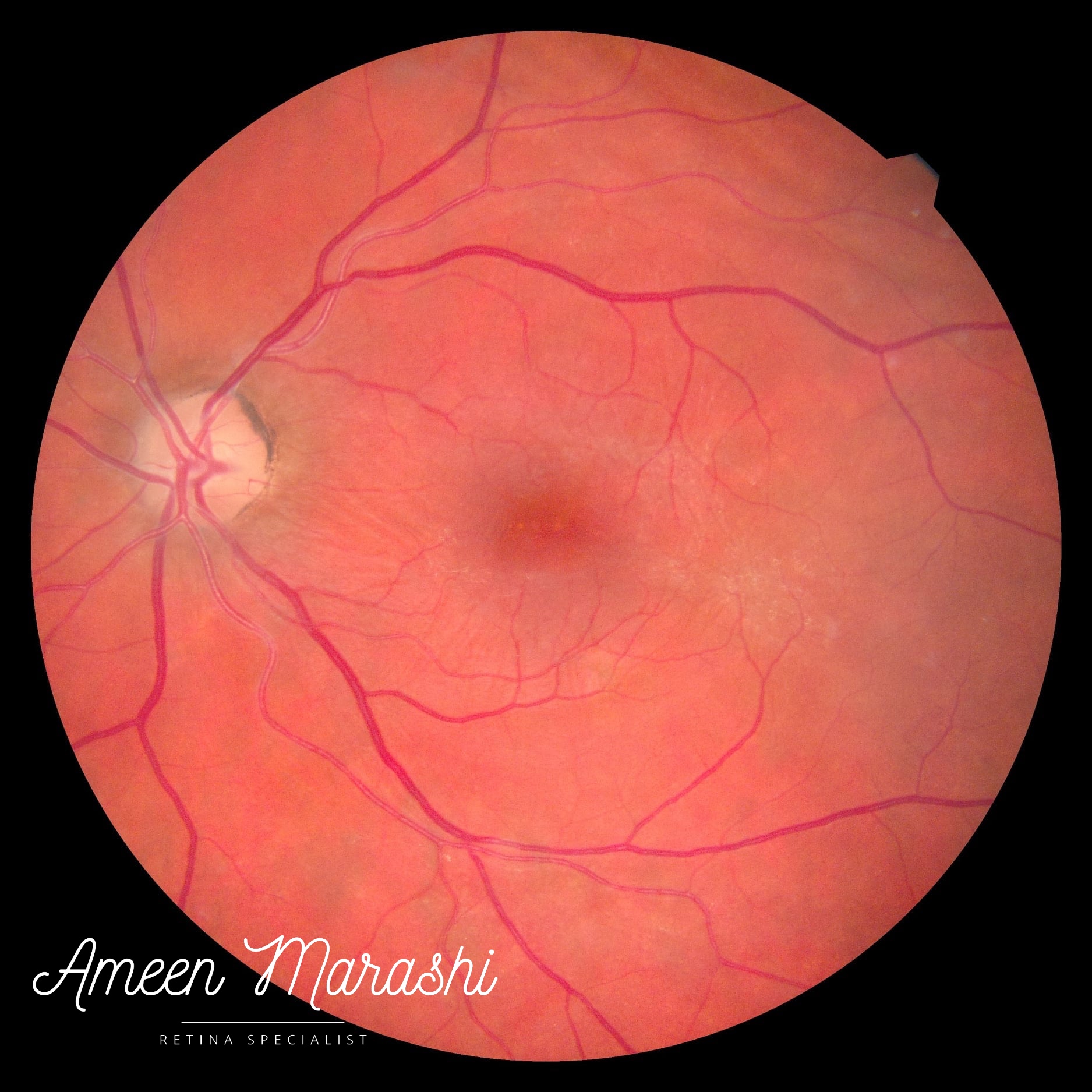 Cellophane maculopathy