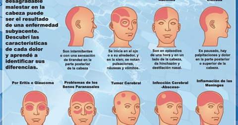 cefaleas: ubicación de las cefaleas