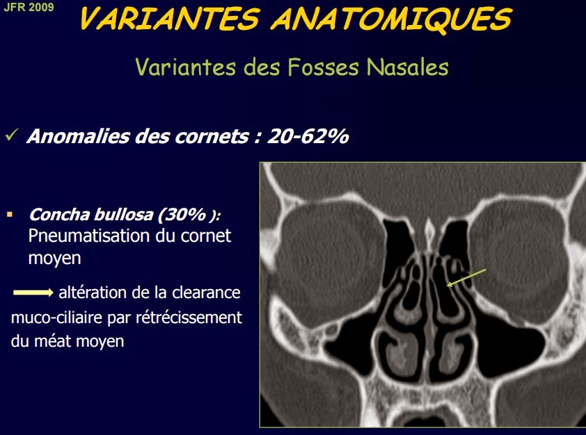 Ma bibliothèque en Imagerie Médicale: VARIANTES ANATOMIQUES DES SINUS