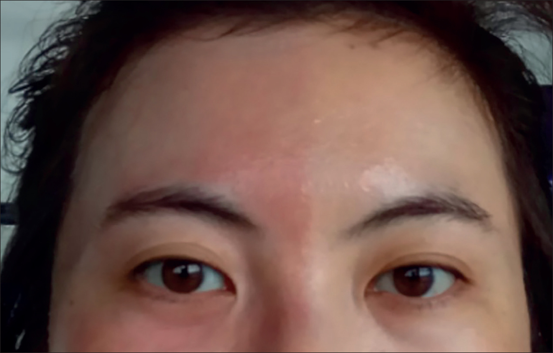 Harlequin Syndrome, Diagnosis, Symptoms and Treatment