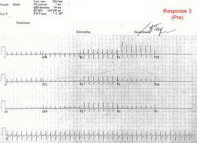 Pedi cardiology: Narrow Complex Tachycardia/SVT - 3 types of responses ...