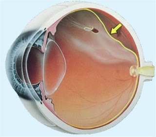 Photopsia Meaning, Definition, Symptoms, Causes, Treatment - Health ...