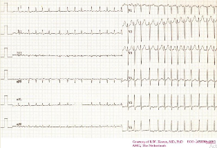 Mengetahui Atrial Fibrillation
