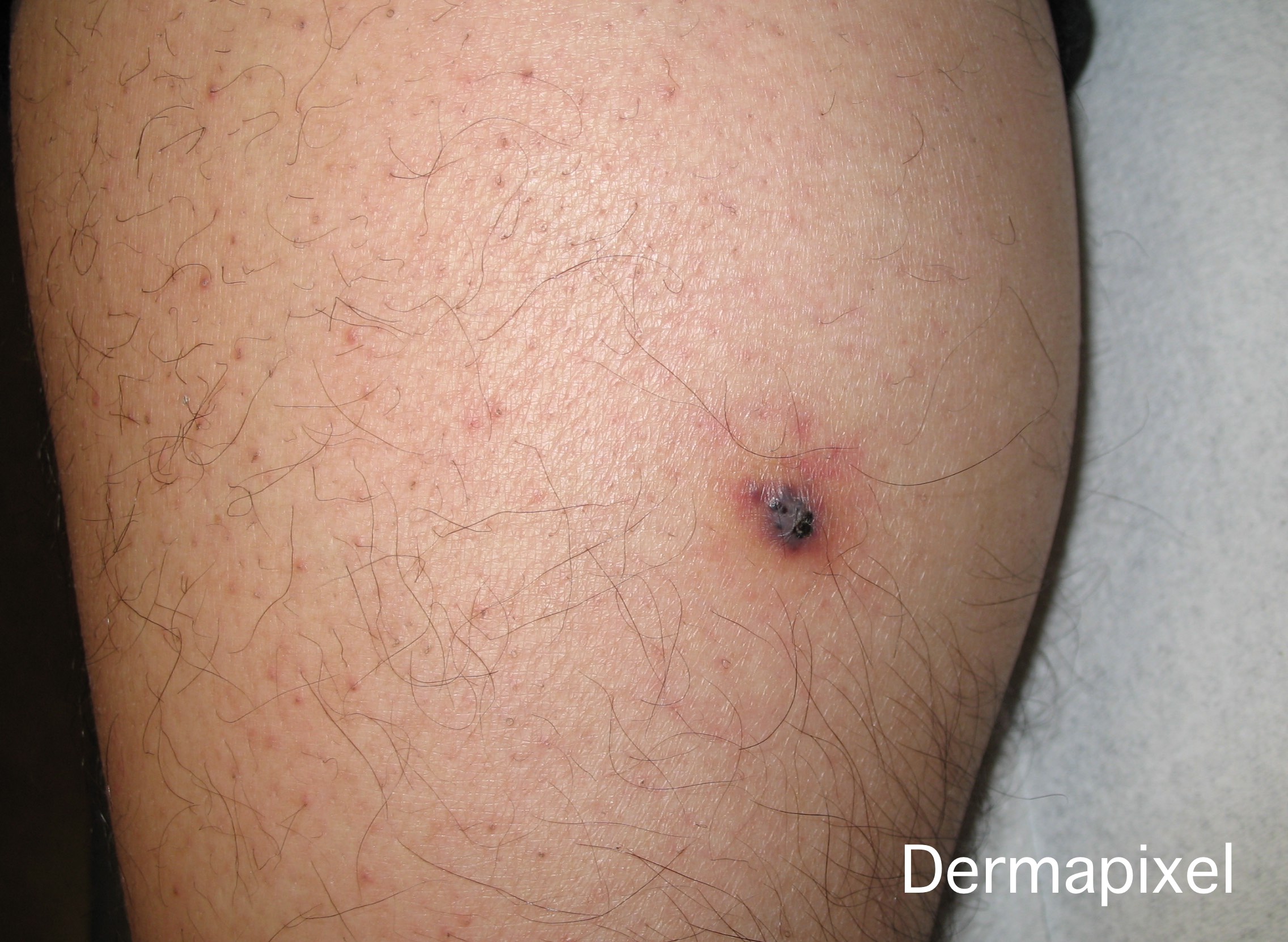 Dermapixel: Una mancha sospechosa