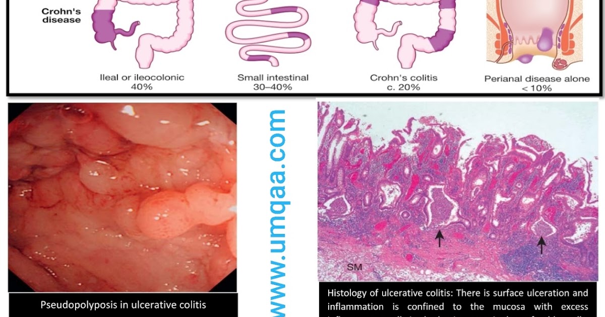 What are the differences between Crohn's disease (CD) and Ulcerative ...