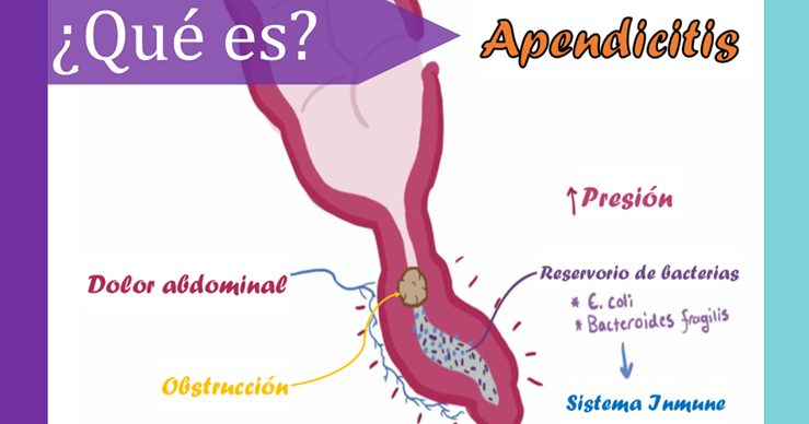 Apendicitis. ¿Qué es? Síntomas y Tratamiento