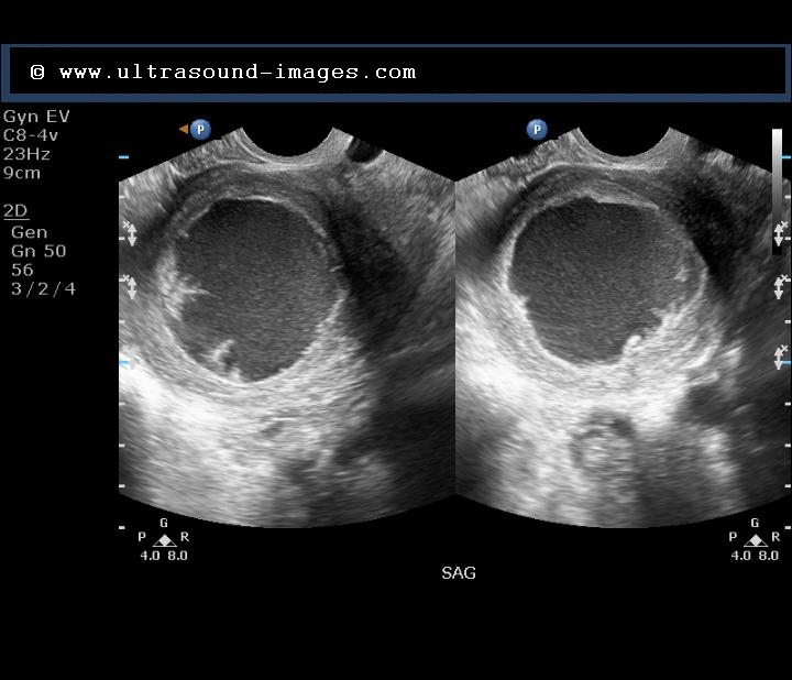 cochinblogs: what is your diagnosis of this cystic lesion?