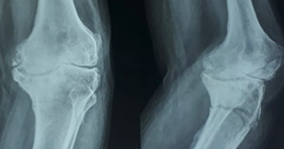 Joint Preservation and Replacement : Tkr in Arthritic knee with tibial ...