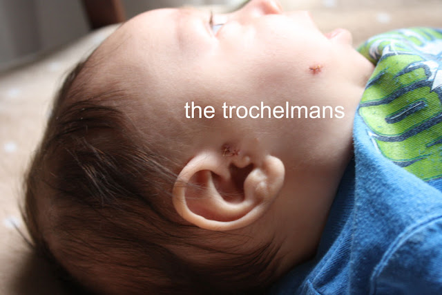 the trochelmans: Skin tag removal on our baby