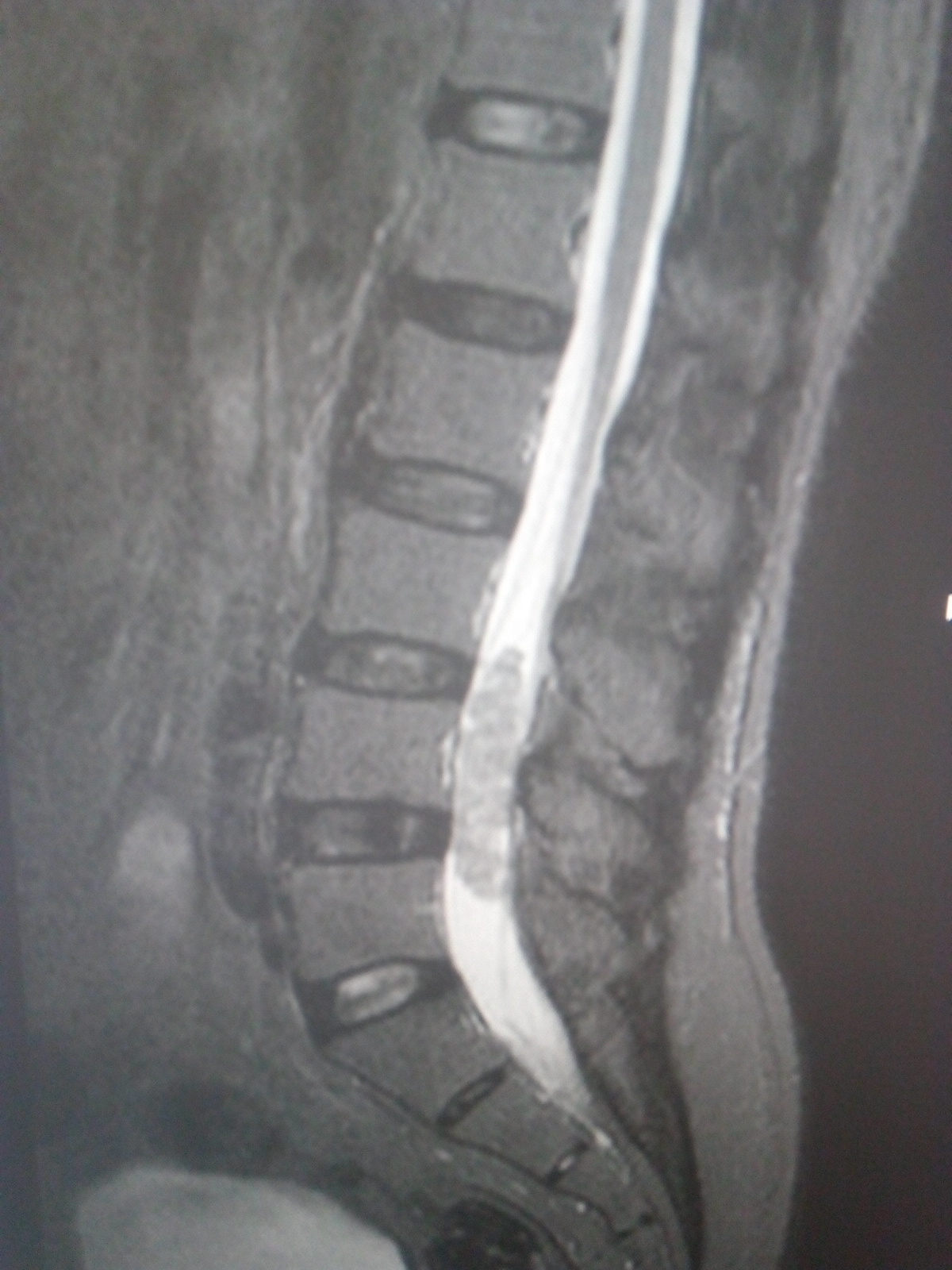 Cauda equina mass: An Approach - Sumer's Radiology Blog