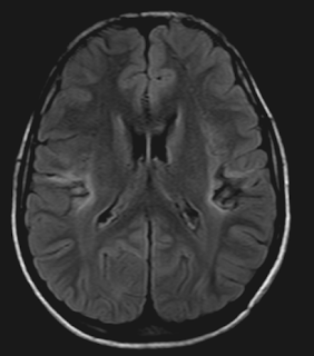 Opercular Syndrome-MRI - Sumer's Radiology Blog