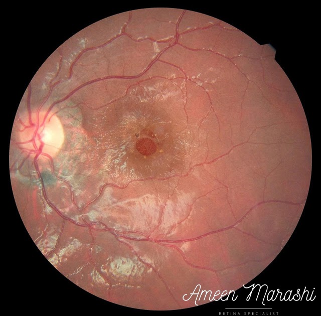 Traumatic macular hole