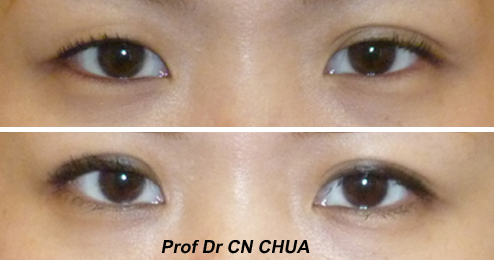 Eyelid Surgery by Prof Dr CN CHUA 蔡鐘能: Case 6: Doctor, Why Are My ...