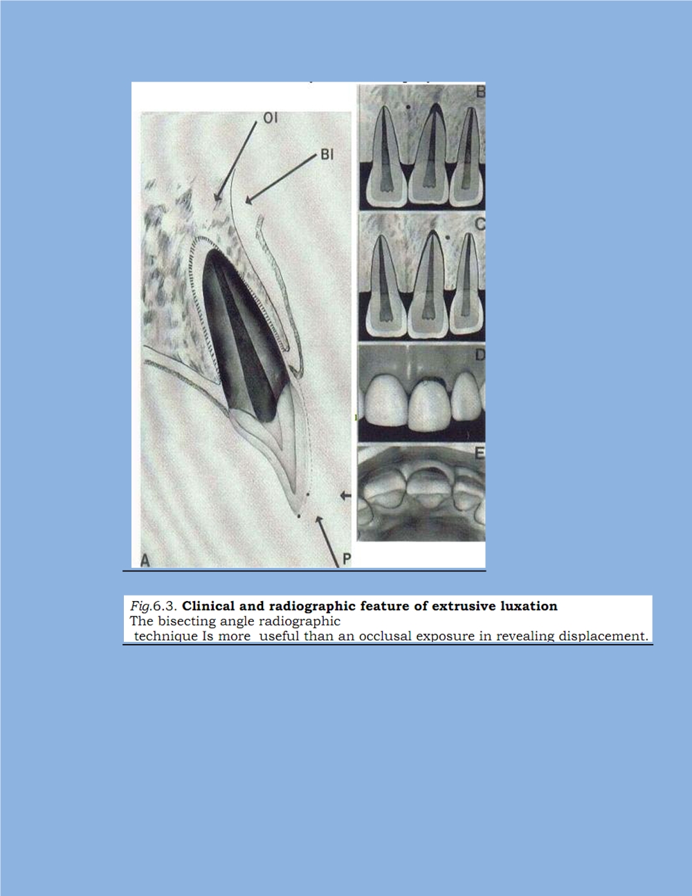 DOs and DONTs in DENTISTRY: CONCUSSION ,SUBLUXATION,EXTRUSION ,LATERAL ...