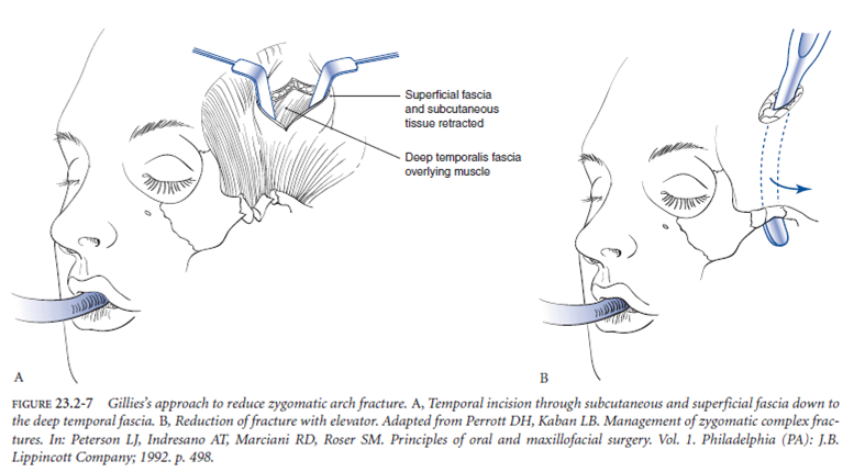 Fraturas do Complexo Zigomático ~ FUTURO CIRURGIÃO BUCOMAXILO FACIAL