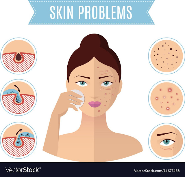 Acne Treatment Blog: How do pimples and blackheads develop and why do ...