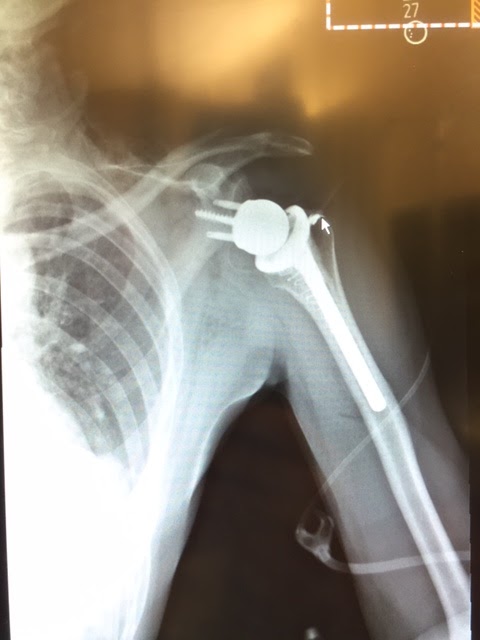 Shoulder and Elbow Surgery: Reverse shoulder replacement for ...