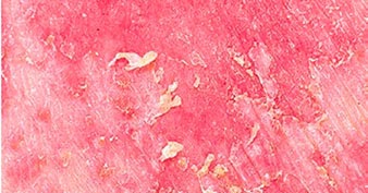 Candidal Intertrigo Treatment