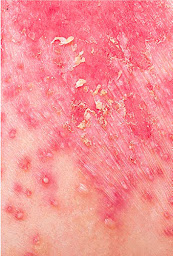 Candidal Intertrigo Treatment